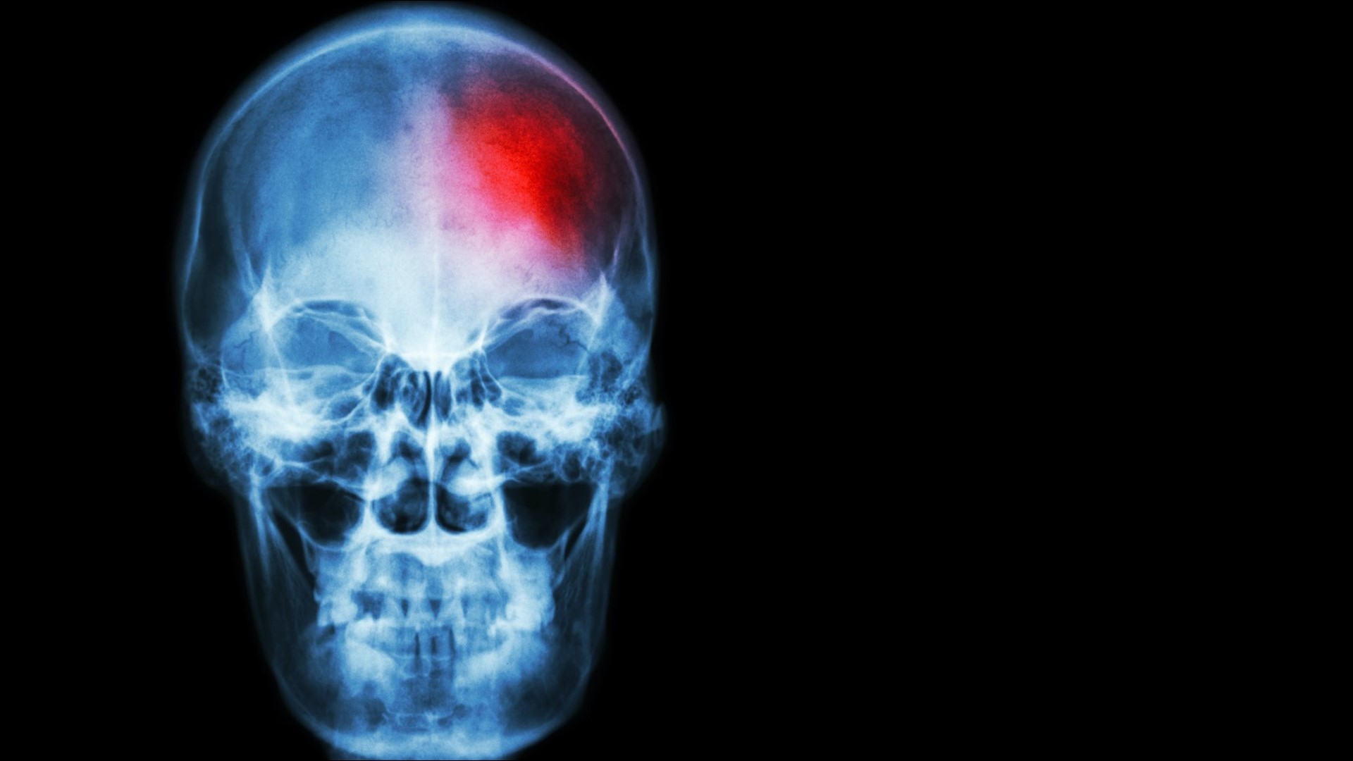 CTE symptoms also seen in veterans, domestic violence patients | wtsp.com