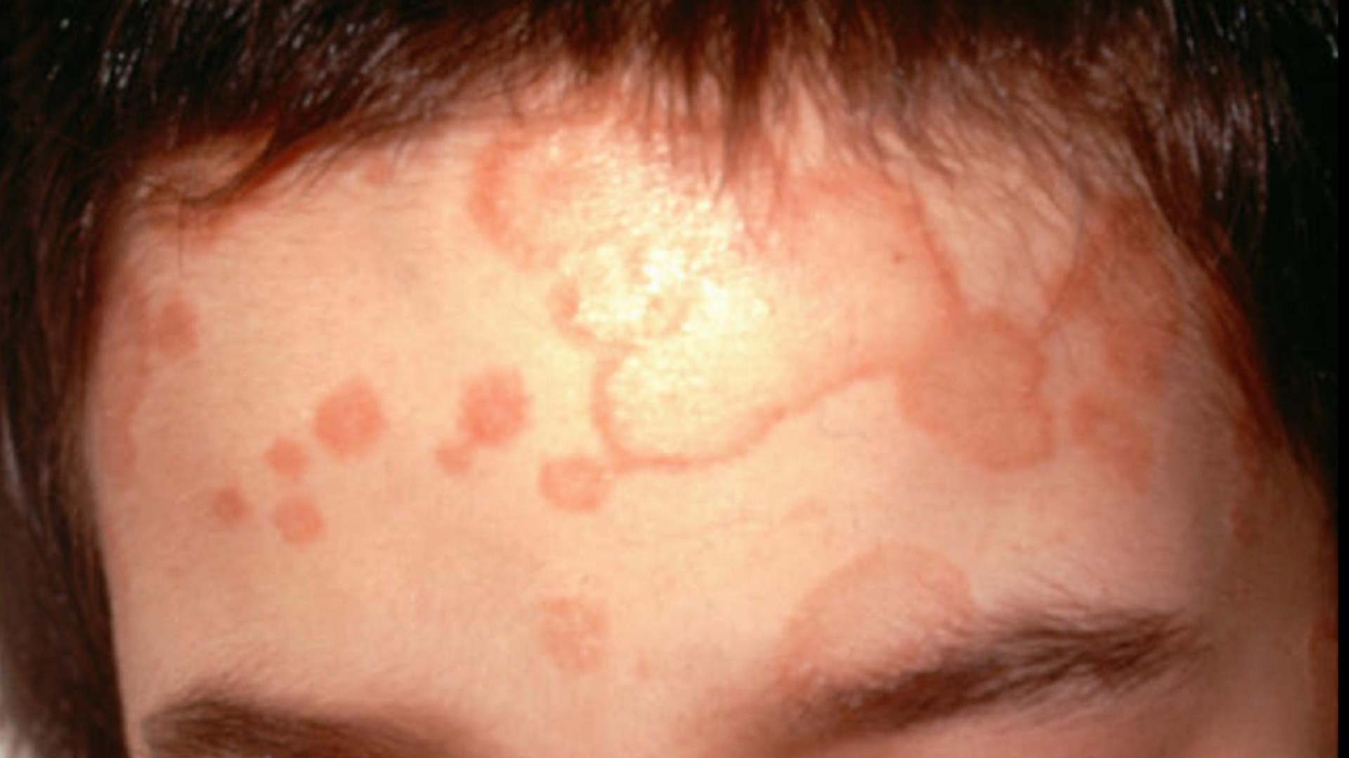 Treatment-resistant ringworm infections seen in U.S. | wtsp.com