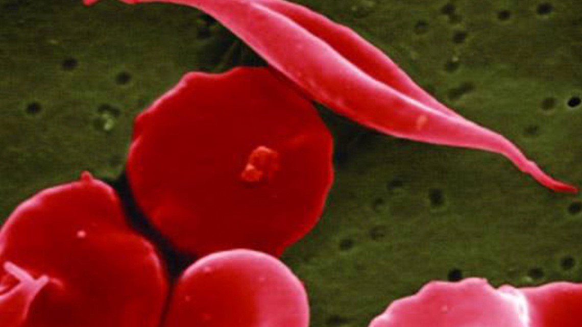 FDA approves sickle cell treatments, including 1 using CRISPR | wtsp.com