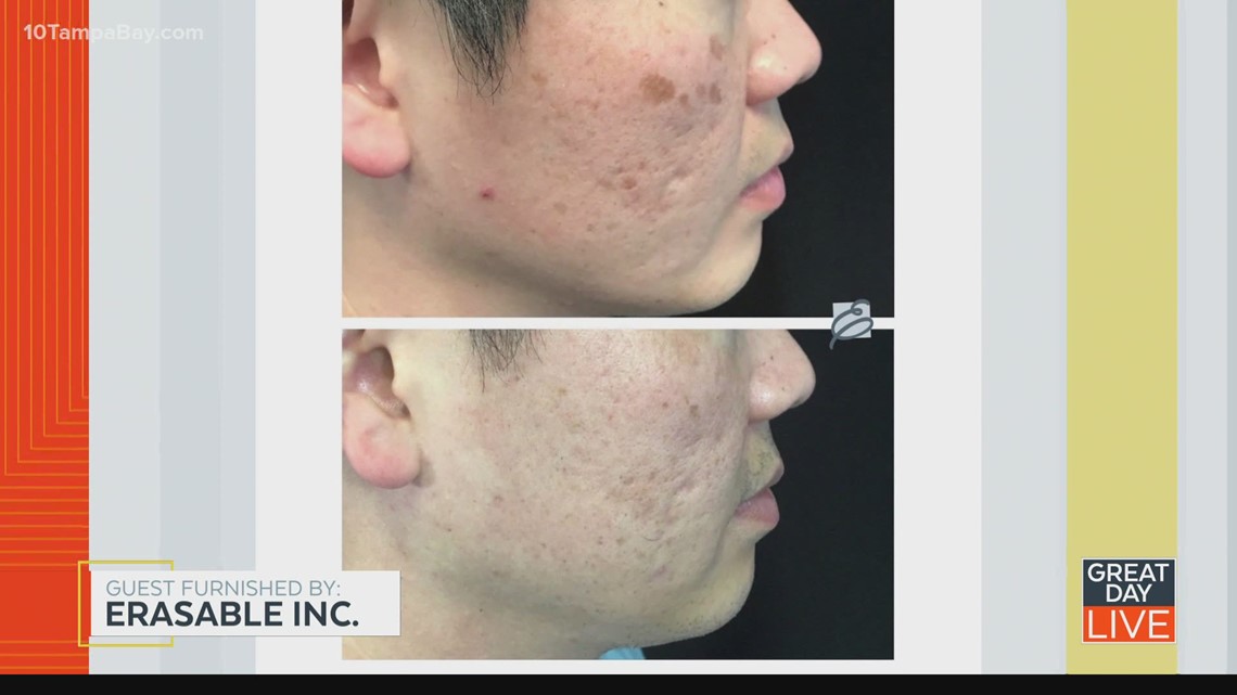 Treating melasma: How to diminish those pesky brown spots | wtsp.com