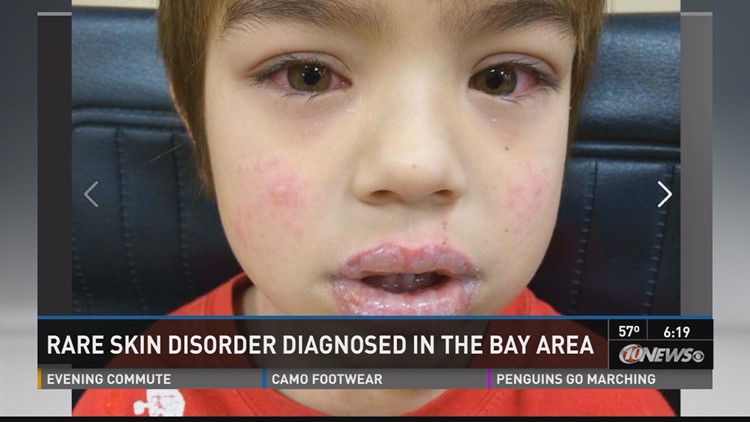 Getting answers: 2 cases of rare skin disease | wtsp.com