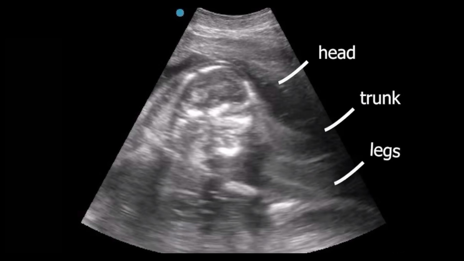 Oklahoma City Zoo shares video of elephant ultrasound | wtsp.com