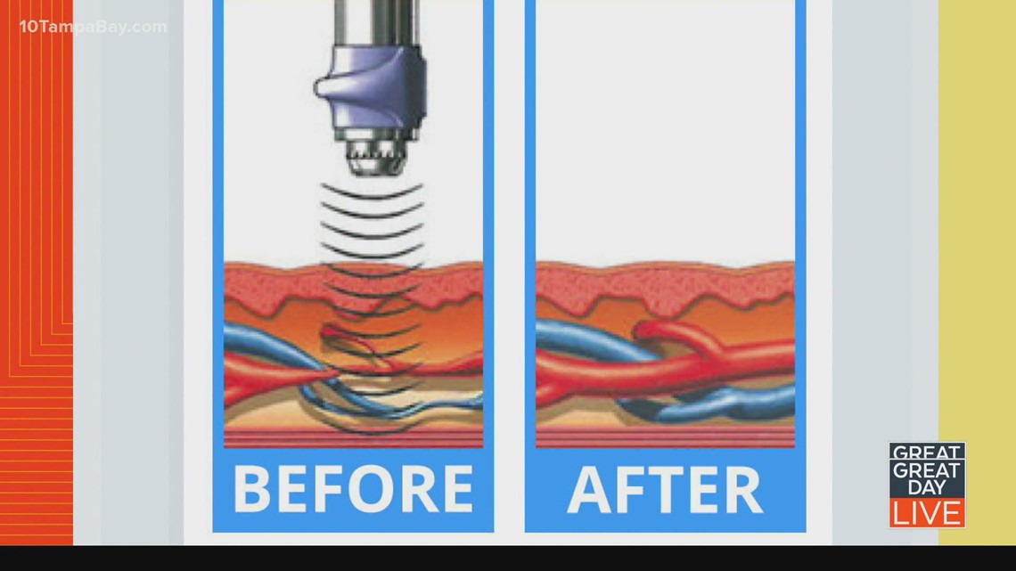 Treat ED without daily medication | wtsp.com