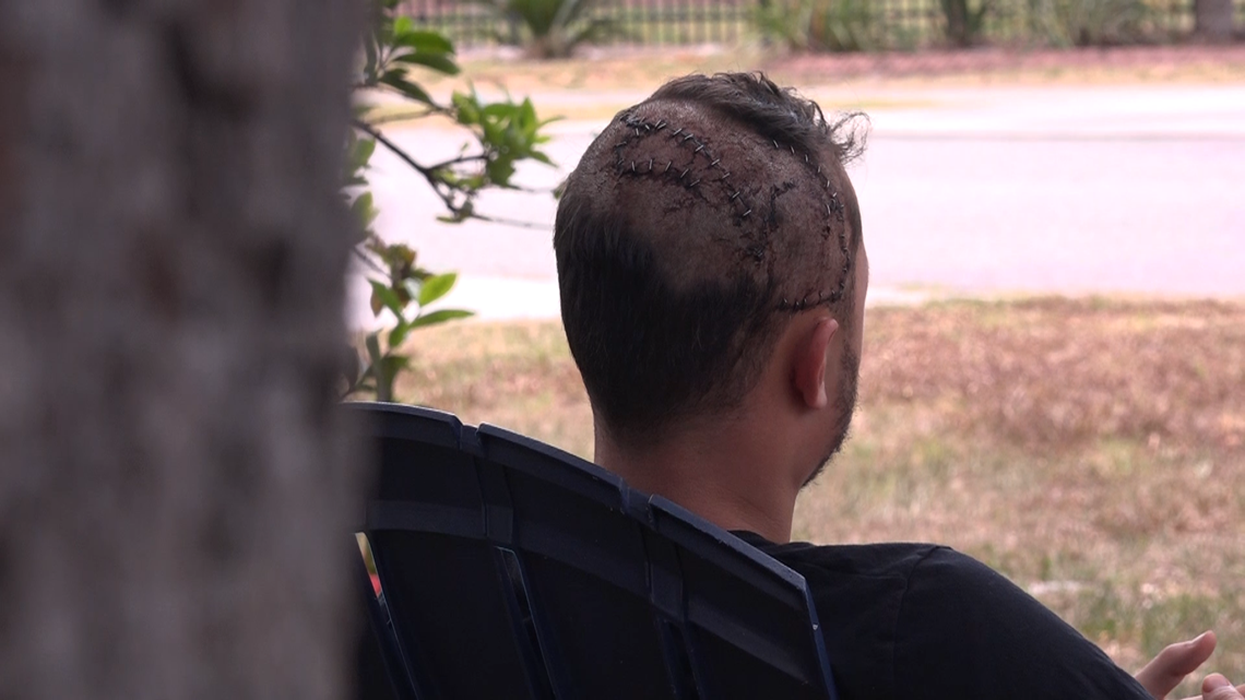 Florida man attacked by gator caught it on GoPro camera | wtsp.com