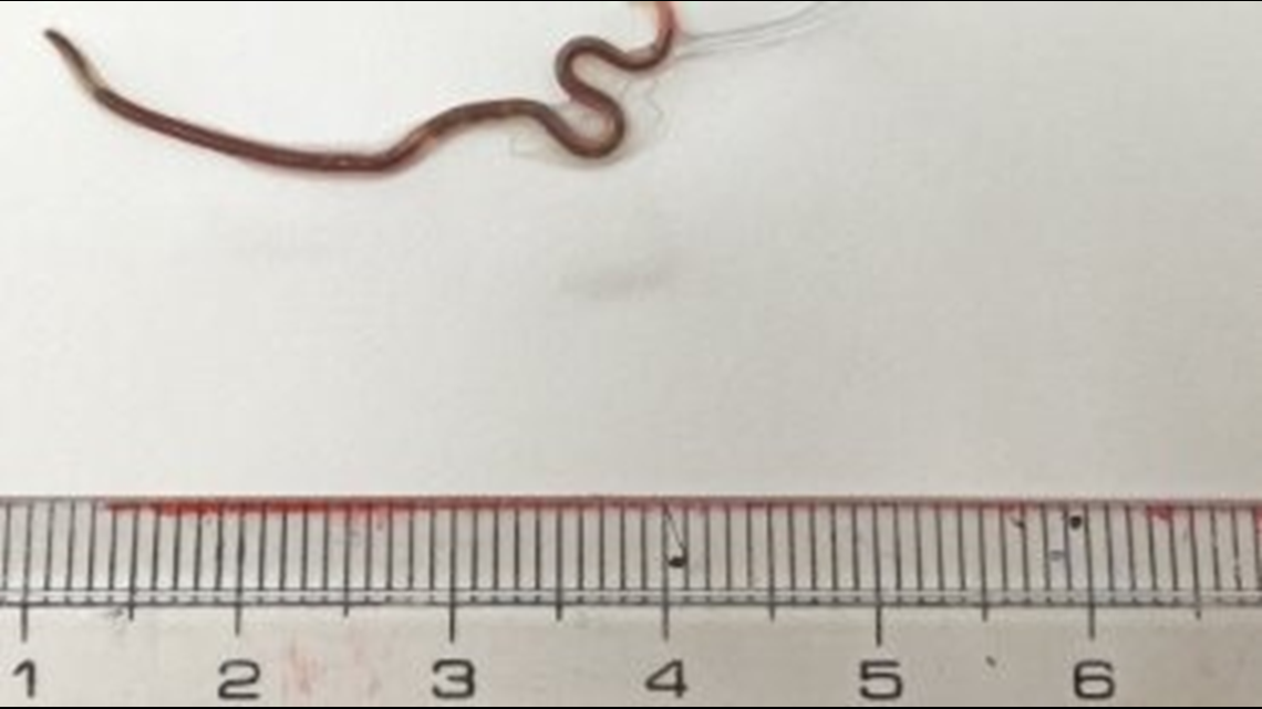 Worm found inside Japanese woman's throat | wtsp.com