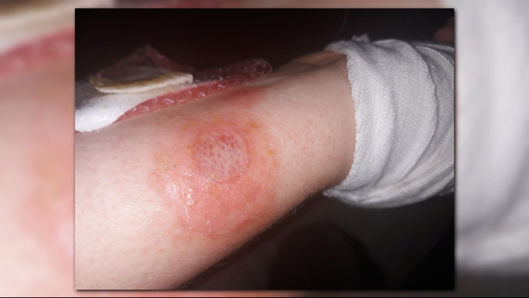 VERIFY: Here's why the 'Deodorant Challenge' causes permanent burn ...