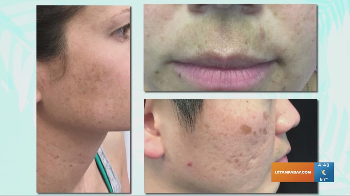 Identifying the causes of melasma and treatment options available ...