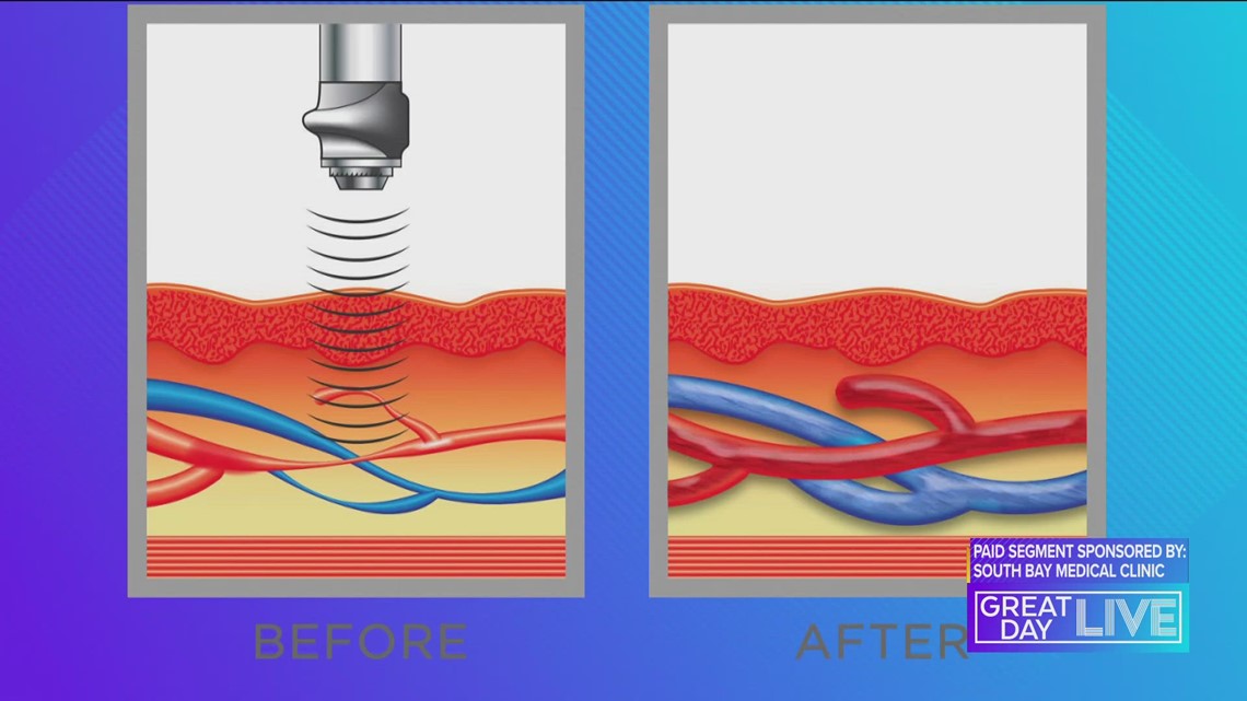 Treat ED without daily medication | wtsp.com