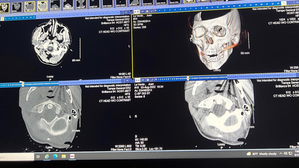 Florida man recounts alligator attack and his recovery journey | wtsp.com