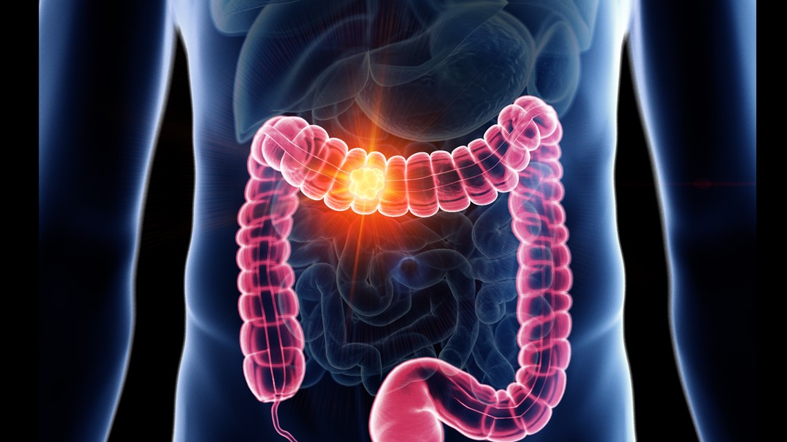 Oncologist recommends getting screened for colon cancer | wtsp.com