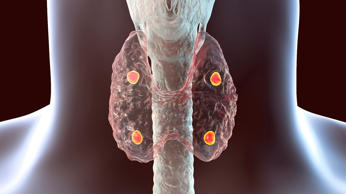 Hyperparathyroidism: What it is, what are the symptoms, treatment ...