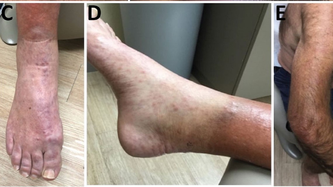 Leprosy in Florida: Your questions answered | wtsp.com